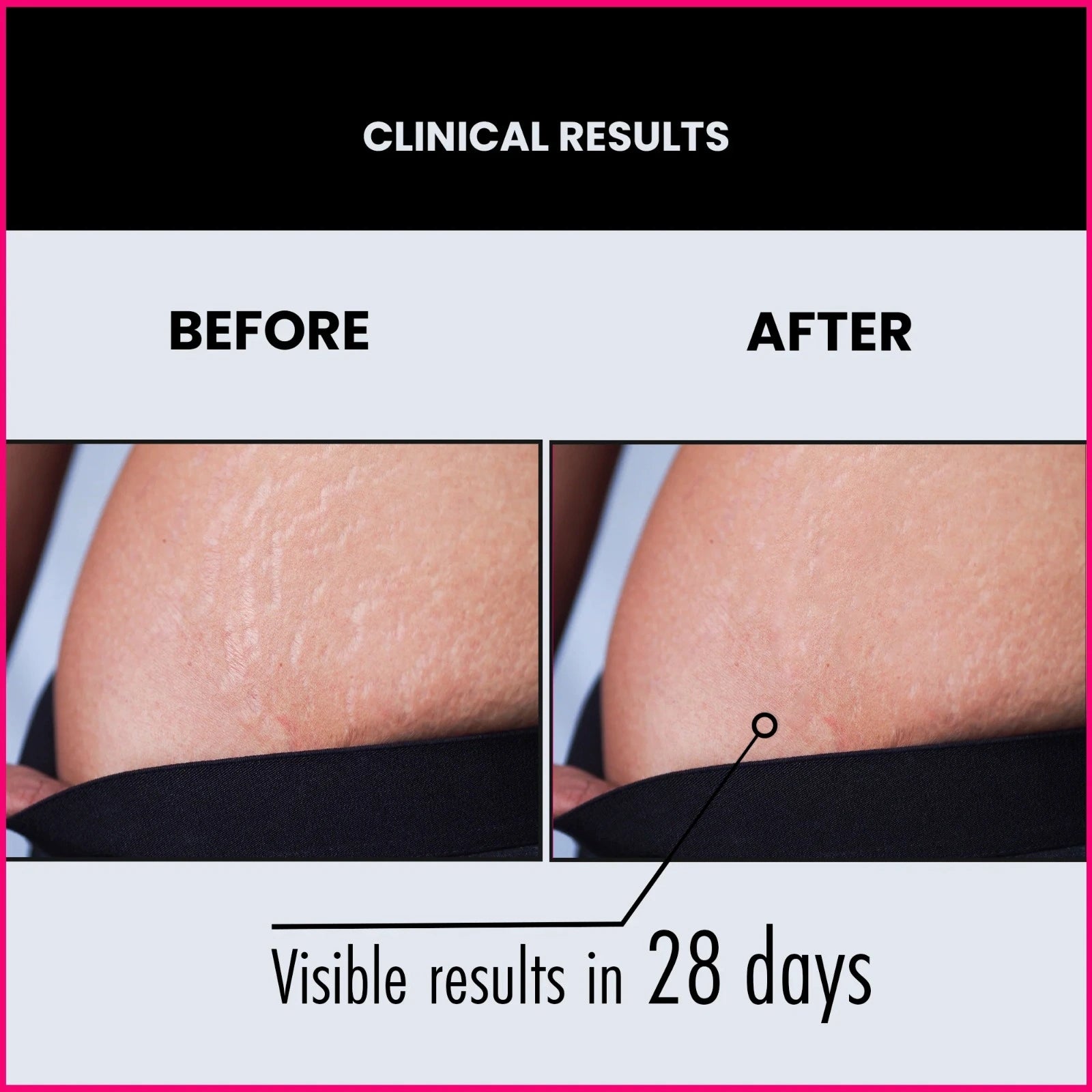 Best Stretch Marks Removal Cream for Women & Men | ThriveCo